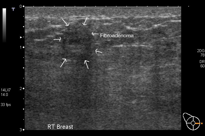 Ultrasound imaging of the lactating breast: methodology and application ...