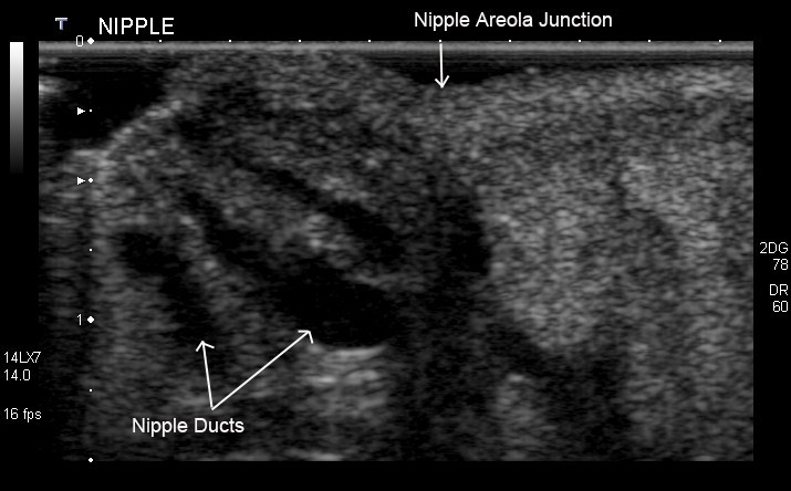 Ultrasound imaging of the lactating breast: methodology and application ...