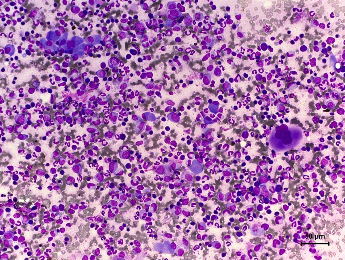 Extramedullary hematopoiesis in a case of benign mixed mammary tumor in ...