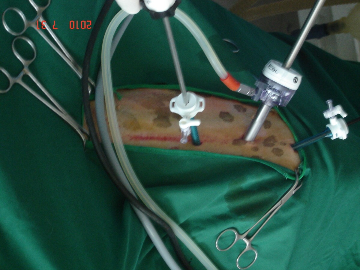 Comparison between single and three portal laparoscopic splenectomy in ...