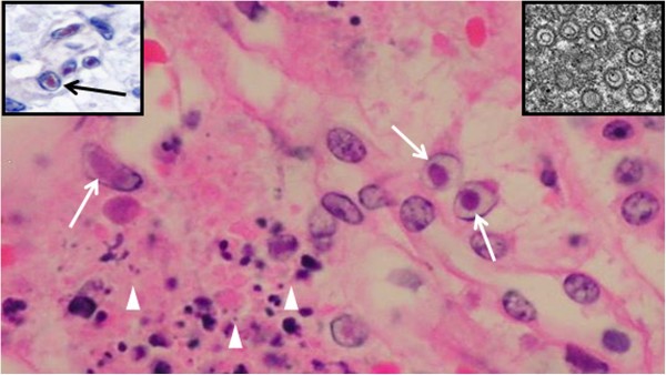 Herpes virus infection associated with interstitial nephritis in a ...