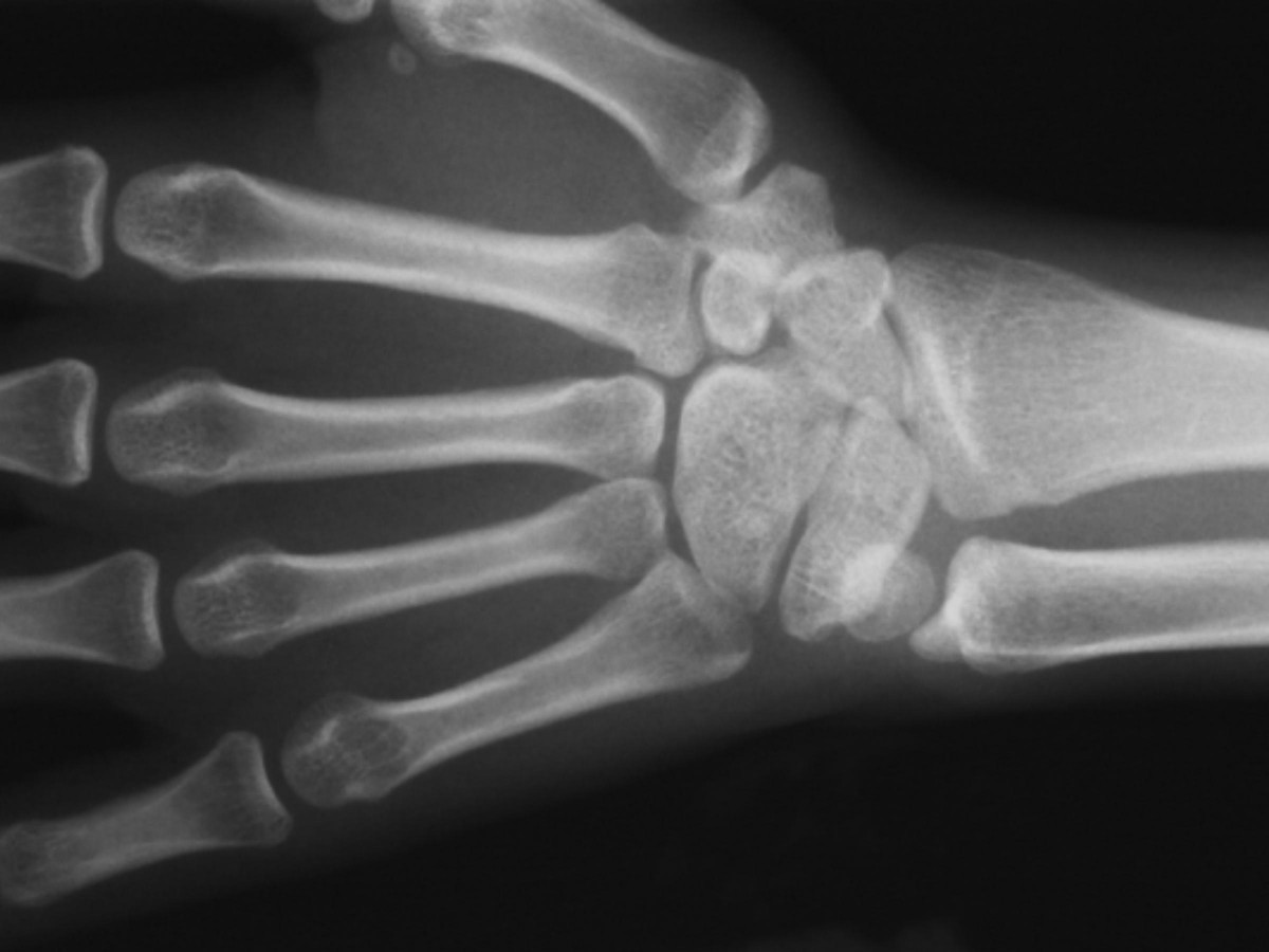 Atlanto-axial rotatory fixation in a girl with Spondylocarpotarsal ...