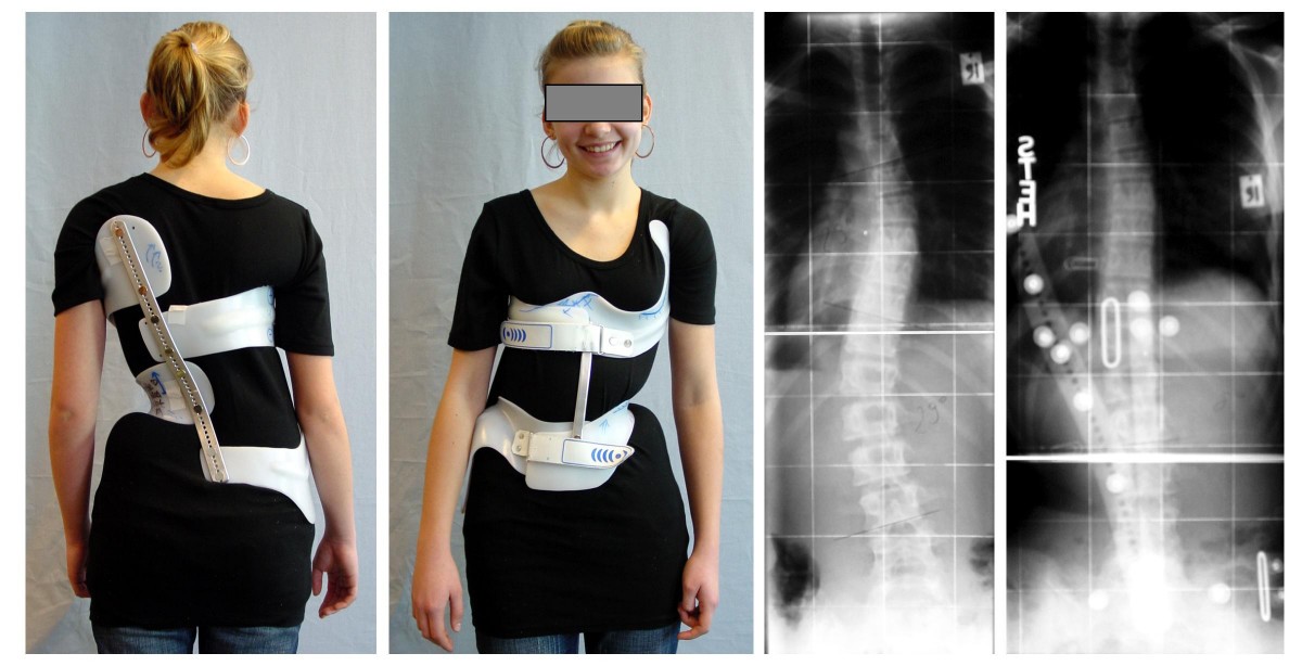 Correction effects of the ScoliOlogiC® „Chêneau light" brace in ...