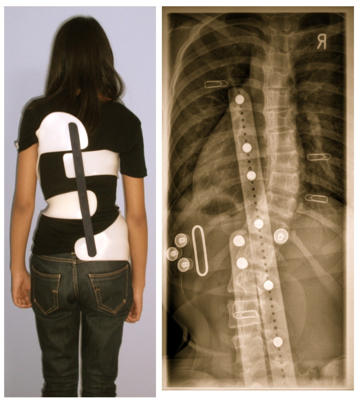 "Brace Technology" Thematic Series - The ScoliOlogiC® Chêneau light ...