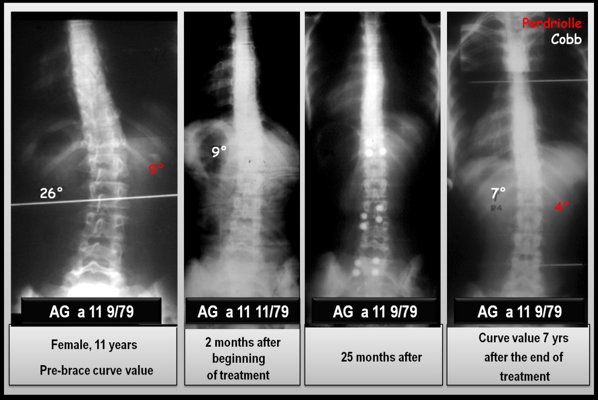 Brace technology thematic series: the progressive action short brace ...