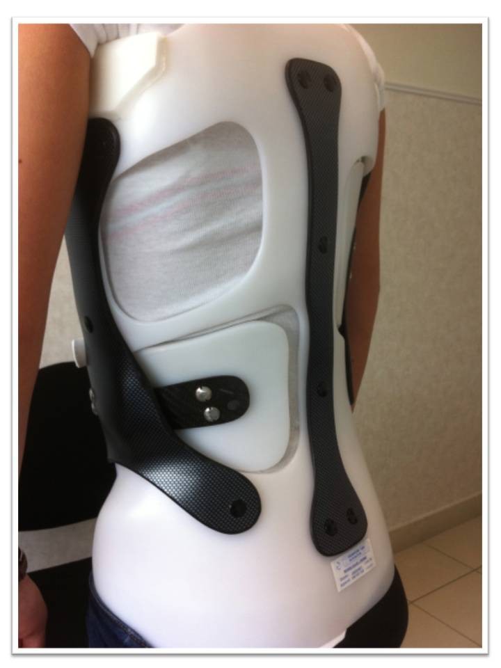 The carbon brace | Scoliosis and Spinal Disorders | Full Text