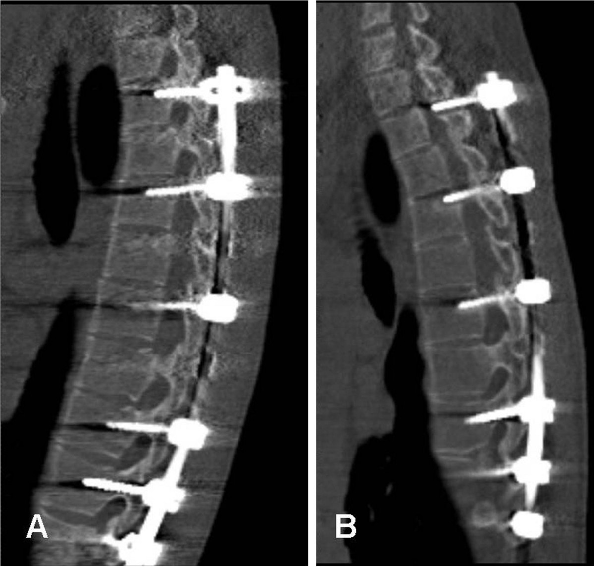 Evaluation of implant loosening following segmental pedicle screw ...