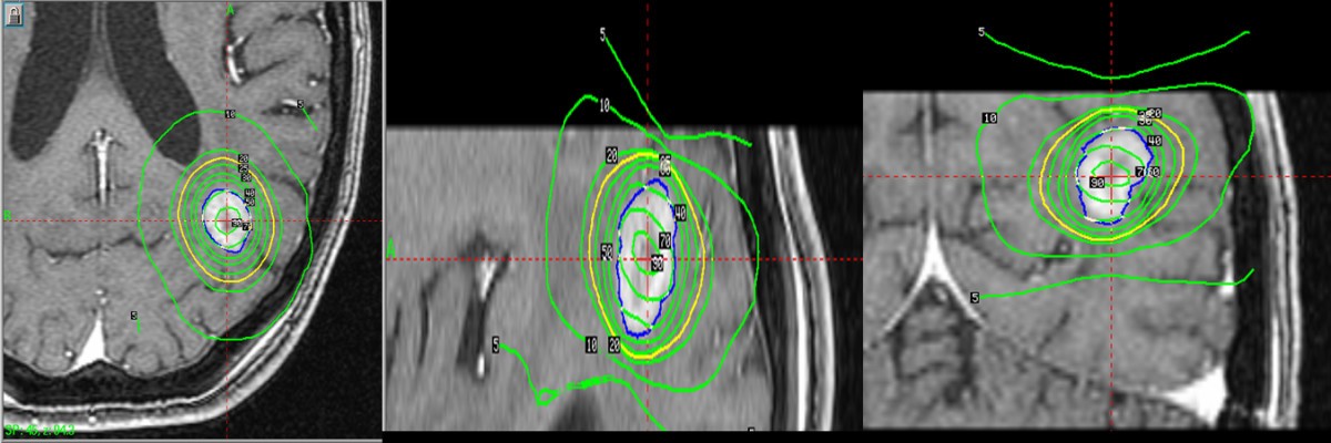 Dosimetric comparison of Helical Tomotherapy and Gamma Knife ...