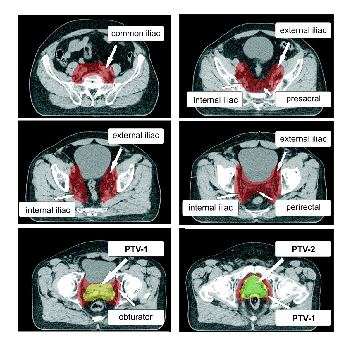 Does Intensity Modulated Radiation Therapy (IMRT) prevent additional ...