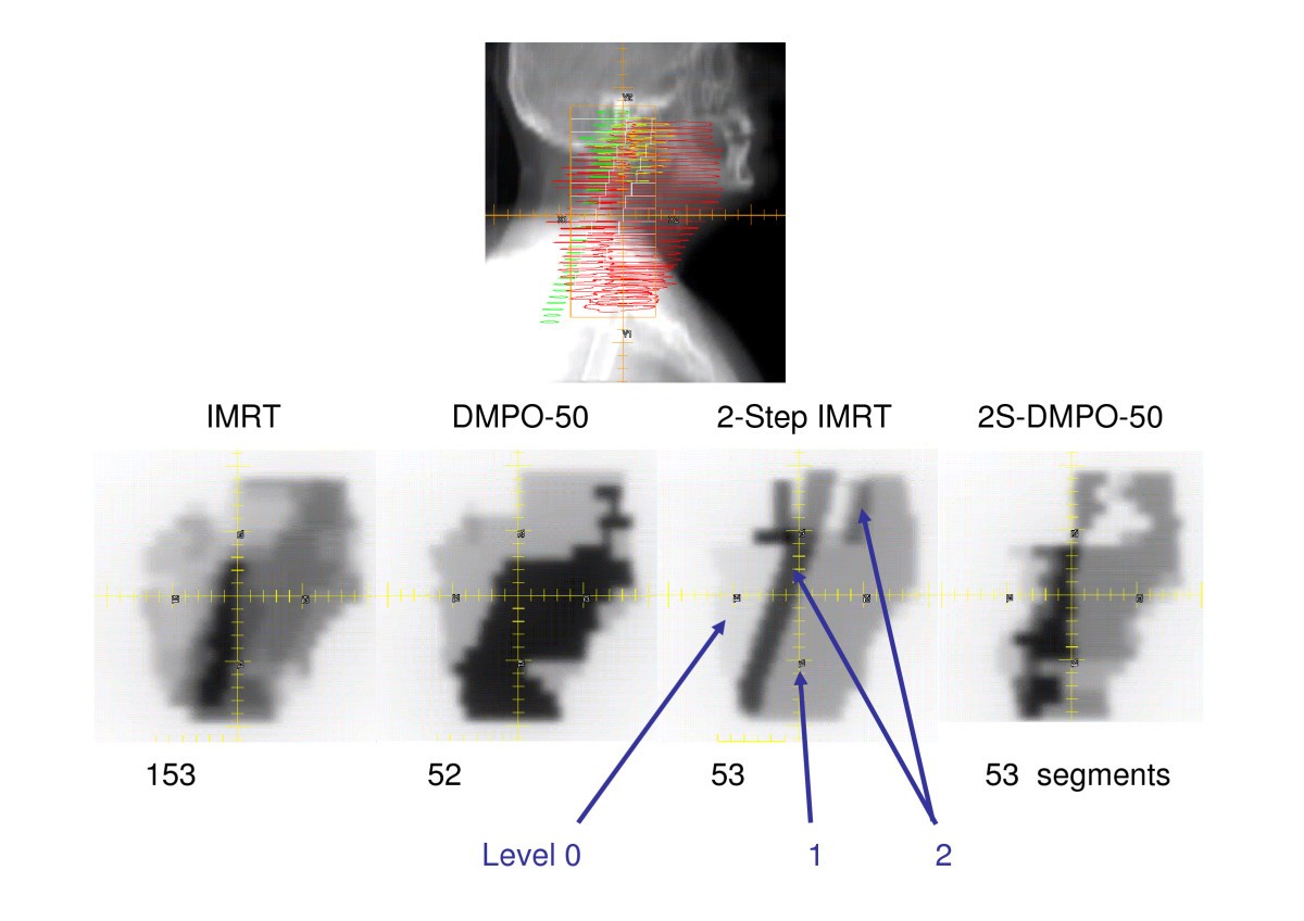 Pre-segmented 2-Step IMRT with subsequent direct machine parameter ...