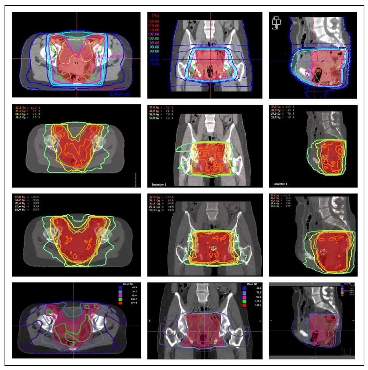 A fast radiotherapy paradigm for anal cancer with volumetric modulated ...