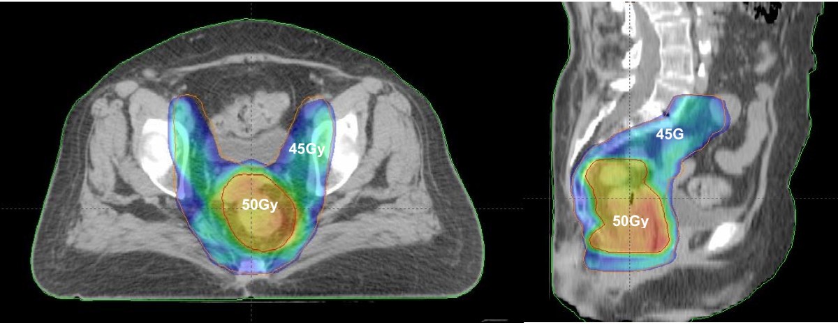 Comparison Of Conformal And Intensity Modulated Radiation Therapy