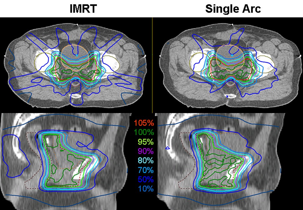 Application of volumetric modulated arc therapy (VMAT) in a dual-vendor ...