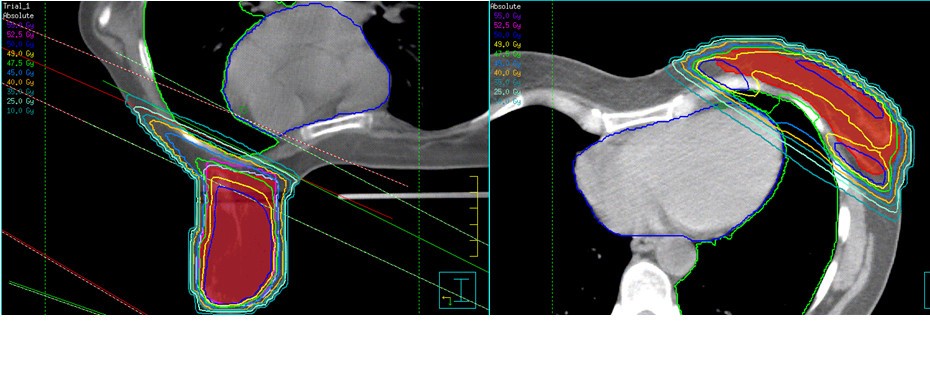 Prone versus supine position for adjuvant breast radiotherapy: a ...