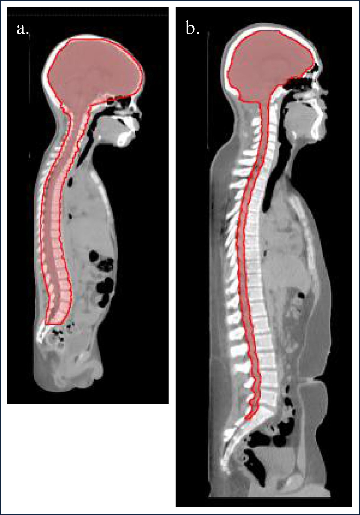 Standardized treatment planning methodology for passively scattered ...