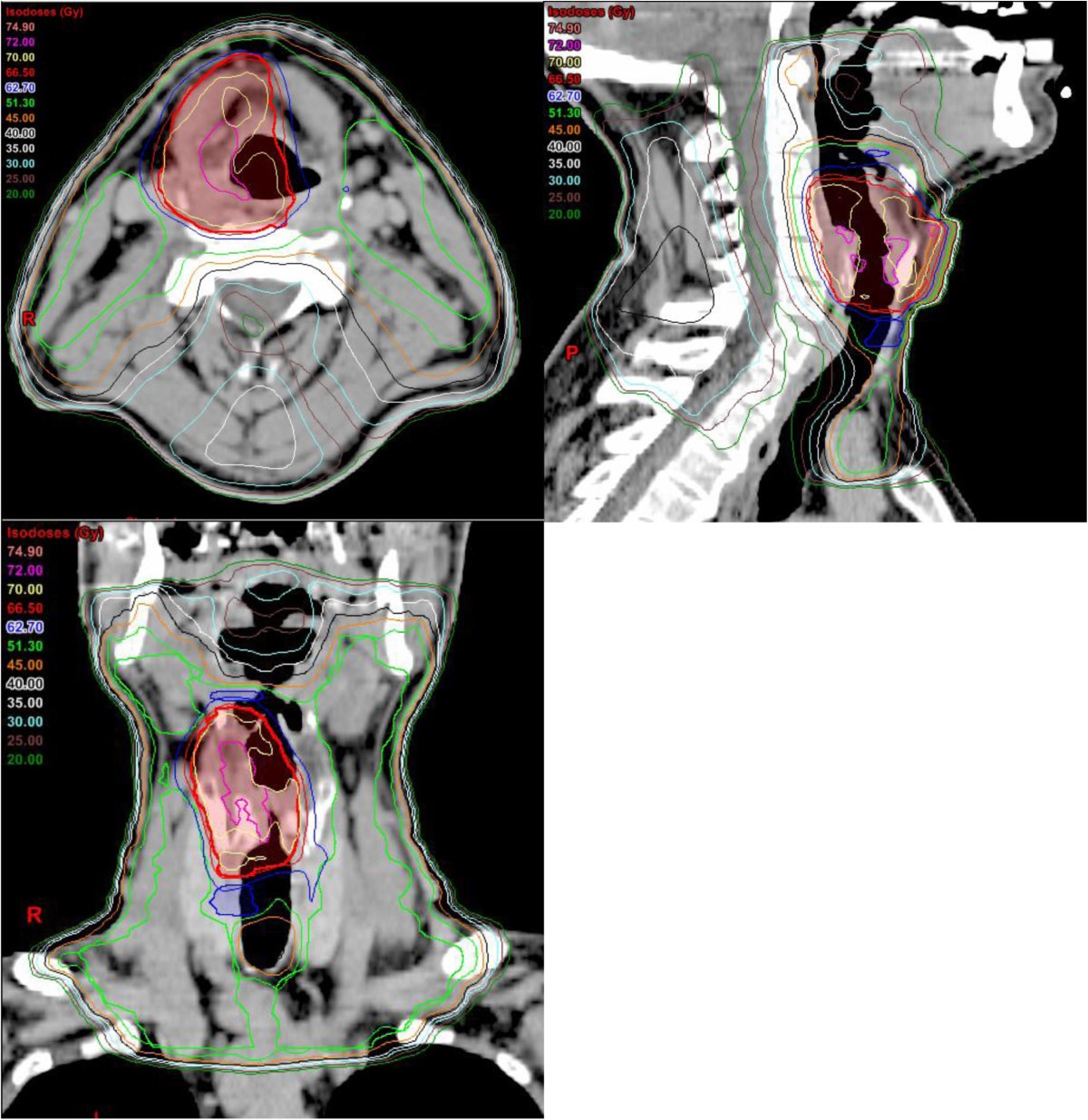 Risk-adapted partial larynx and/or carotid artery sparing modulated radiation therapy of glottic ...