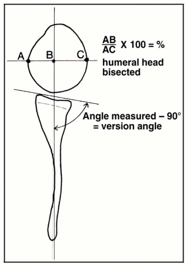 An MRI study on the relations between muscle atrophy, shoulder function ...