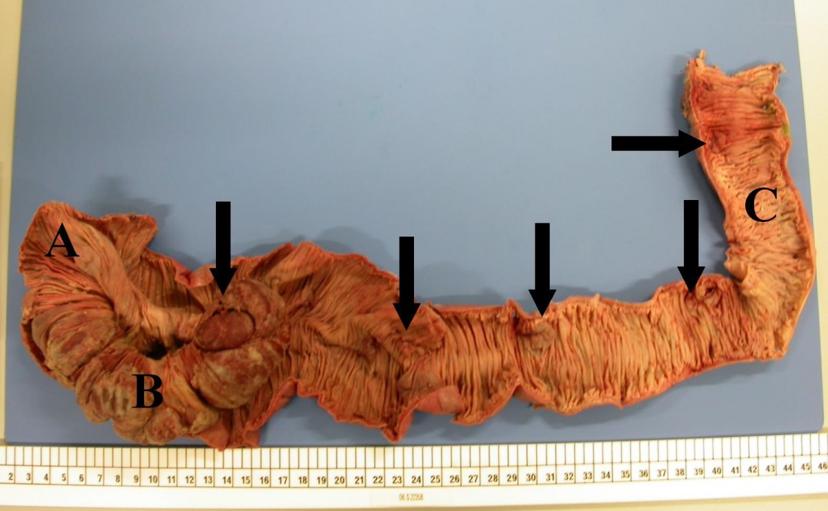Synchronous multiple small bowel intussusceptions in an adult with blue ...