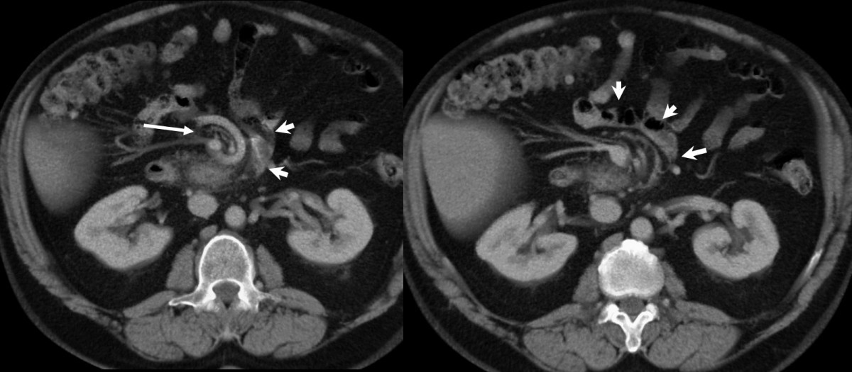 Small bowel haemorrhage associated with partial midgut malrotation in a ...