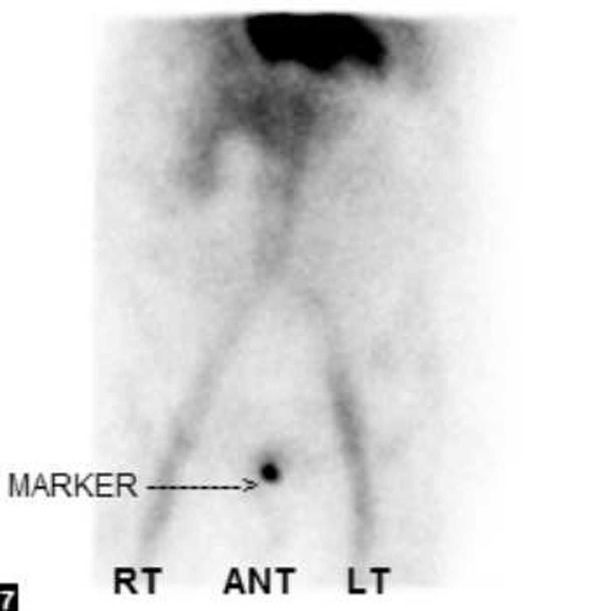 Accurate localization of life threatening colonic hemorrhage during ...