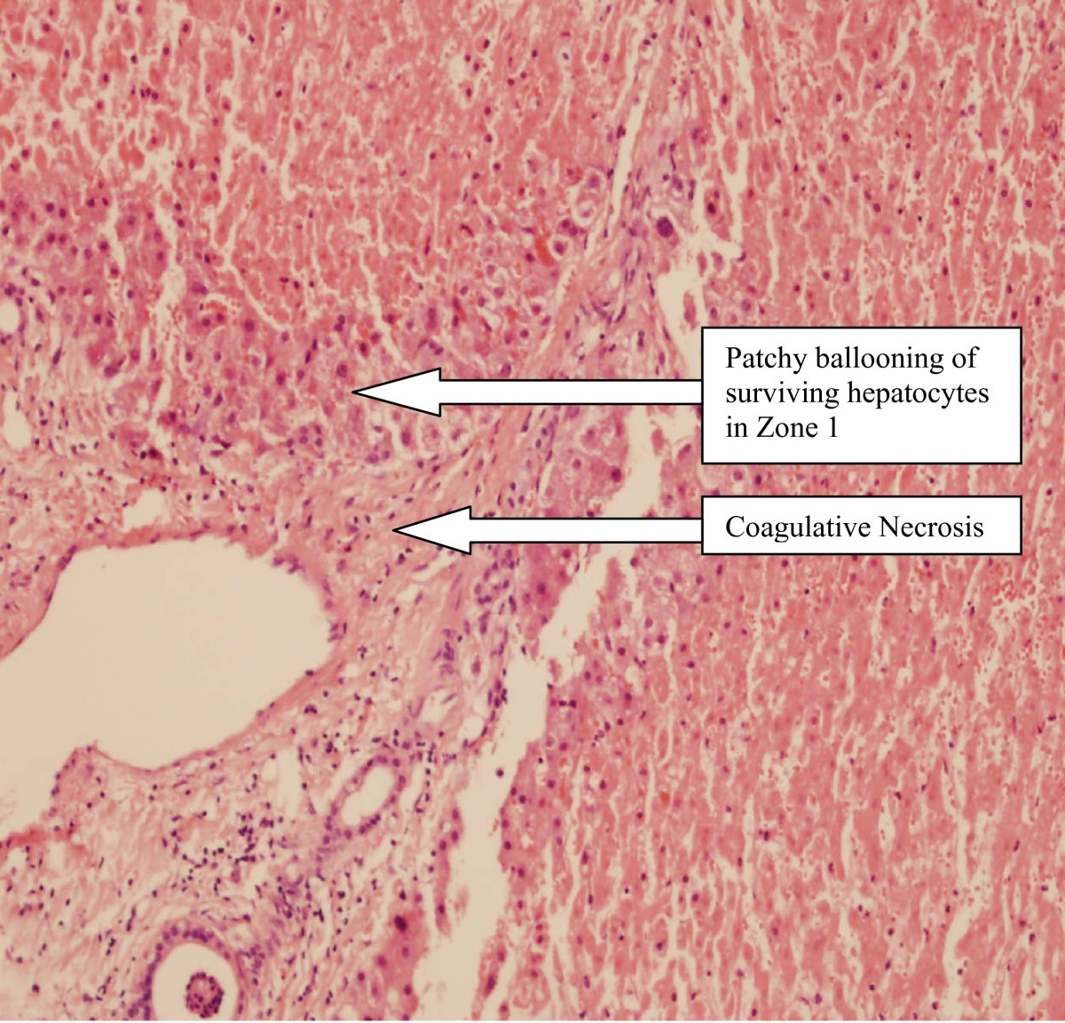 Second trimester hepatic rupture in a 35 year old nulliparous woman ...