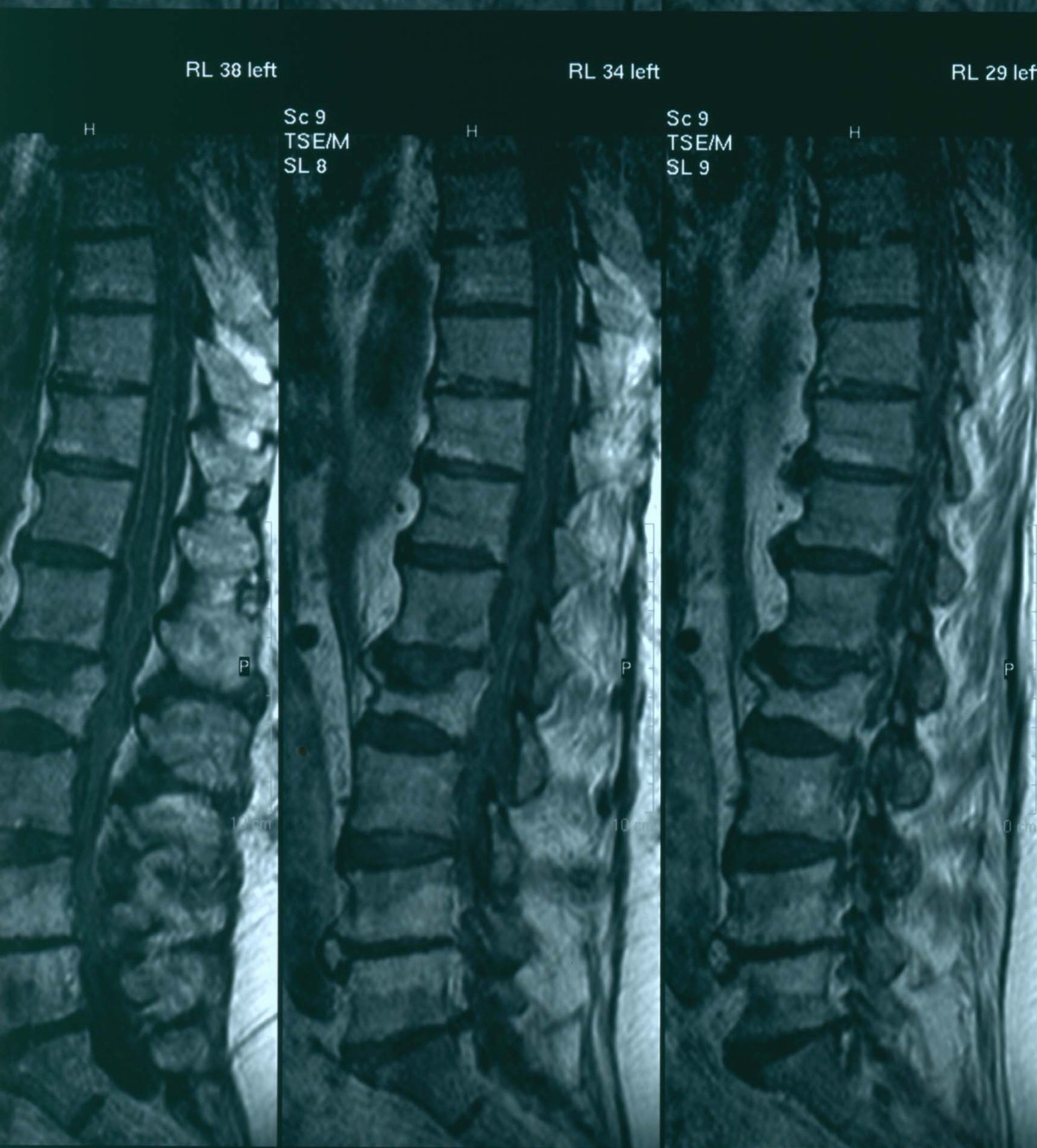 Spinal Subdural Staphylococcus Aureus Abscess: case report and review ...