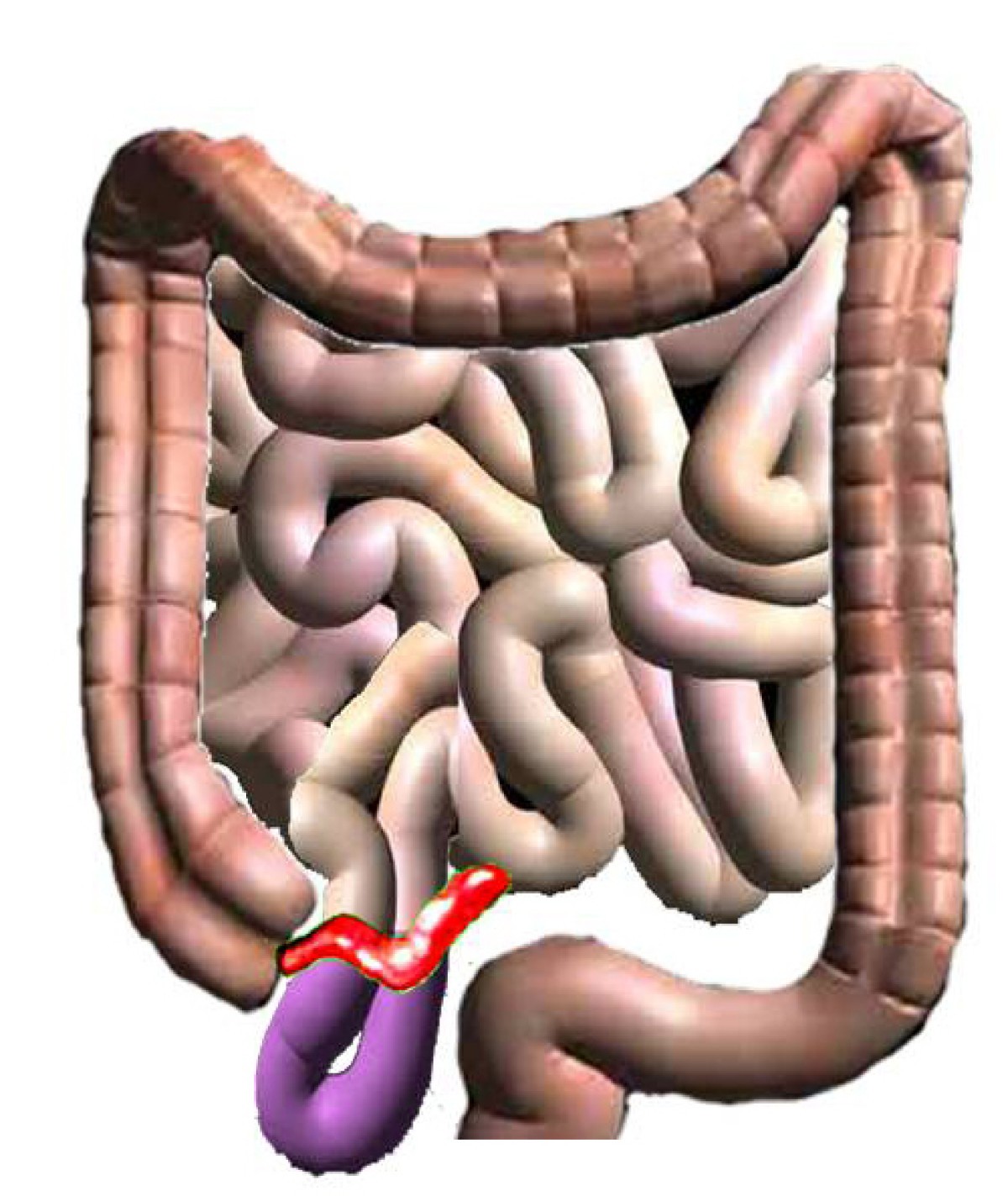 Appendicitis as a cause of intestinal strangulation: a case report and ...