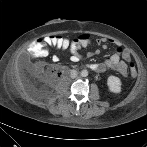 Endoscopic duodenal perforation: surgical strategies in a regional ...