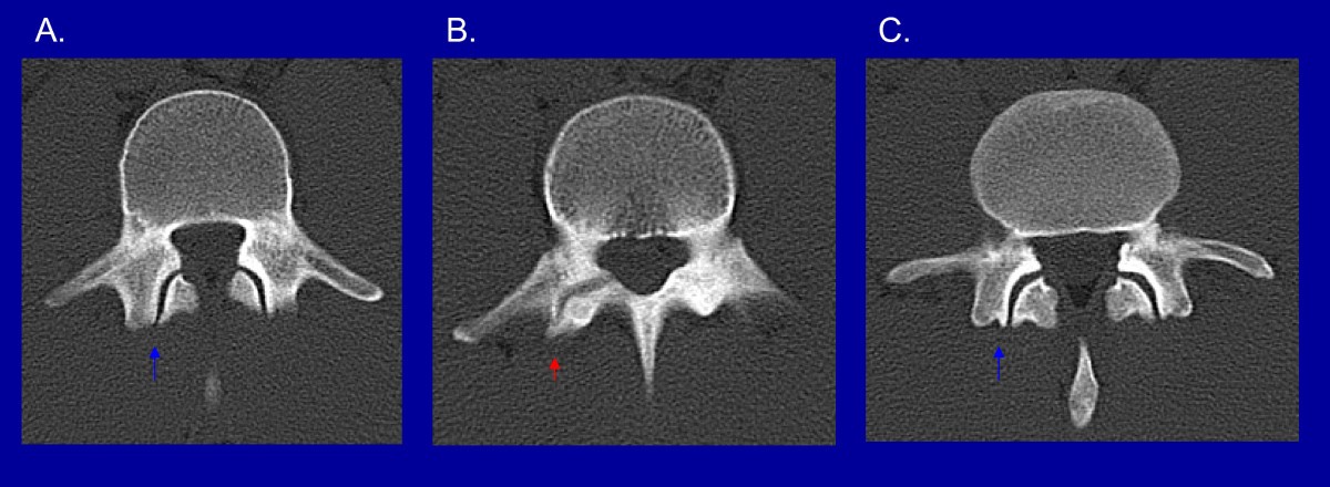 The value of SPECT in the detection of stress injury to the pars ...