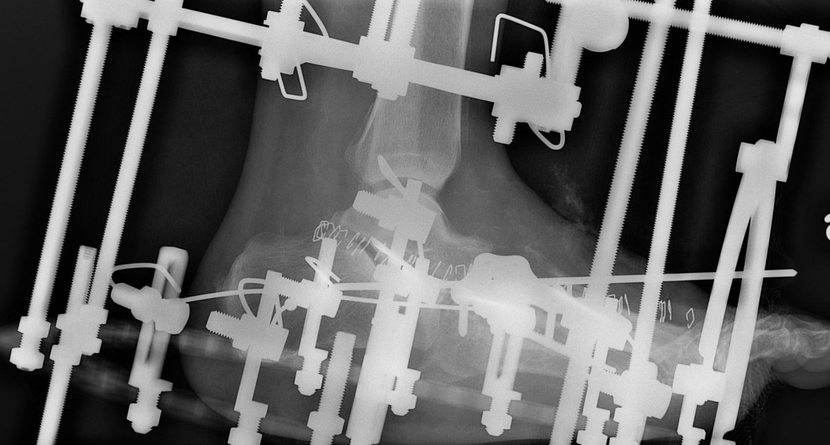Charcot foot reconstruction with combined internal and external ...