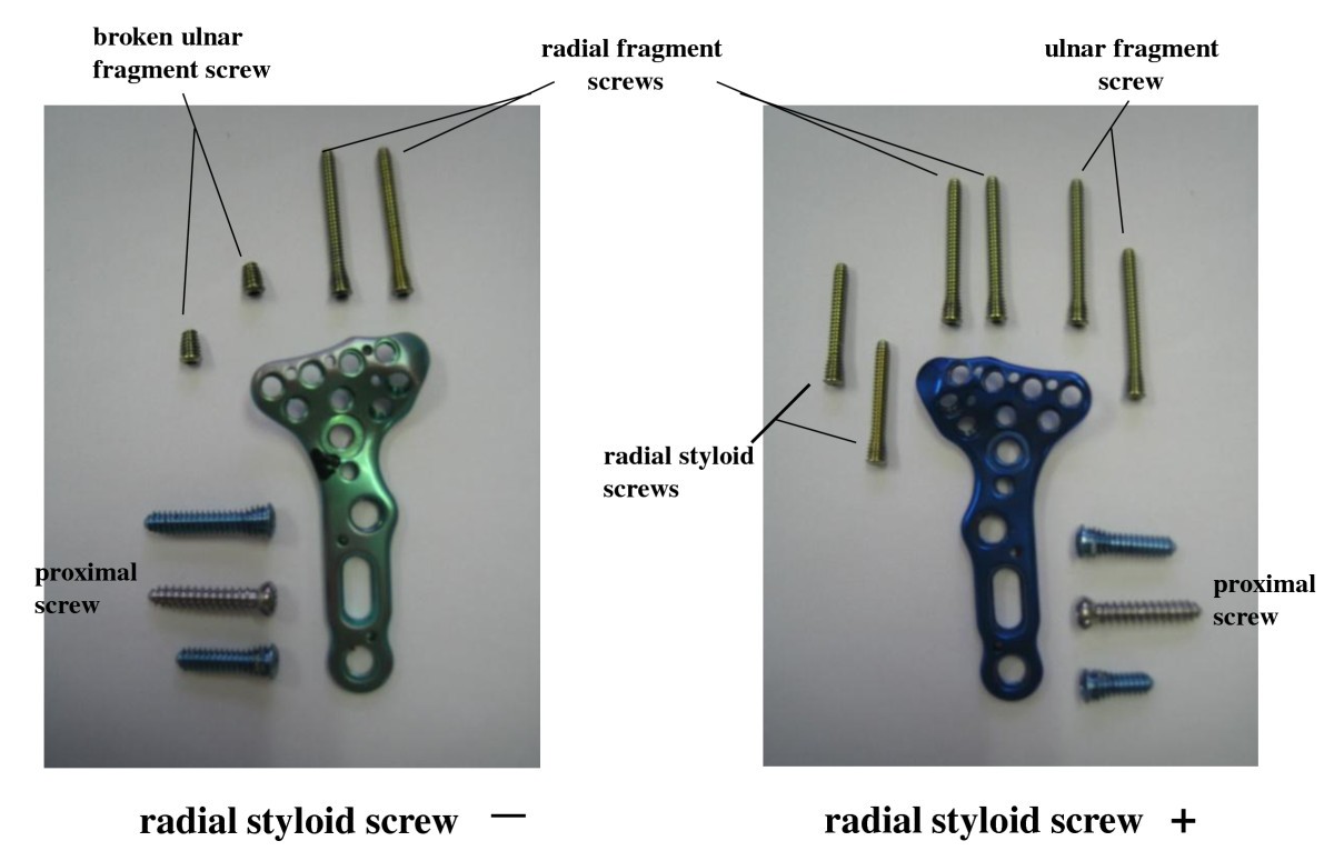 Efficacy of radial styloid targeting screws in volar plate fixation of ...