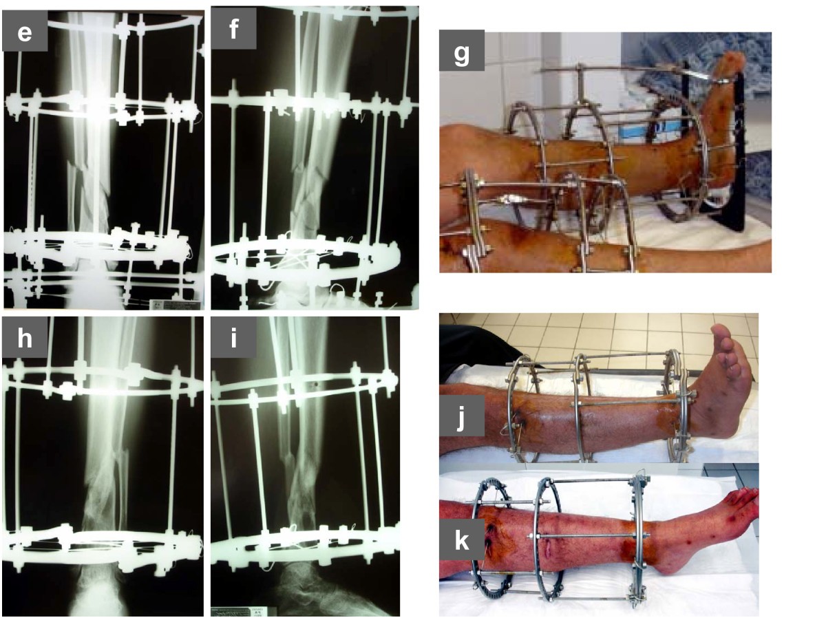 The use of twin-ring Ilizarov external fixator constructs: application ...
