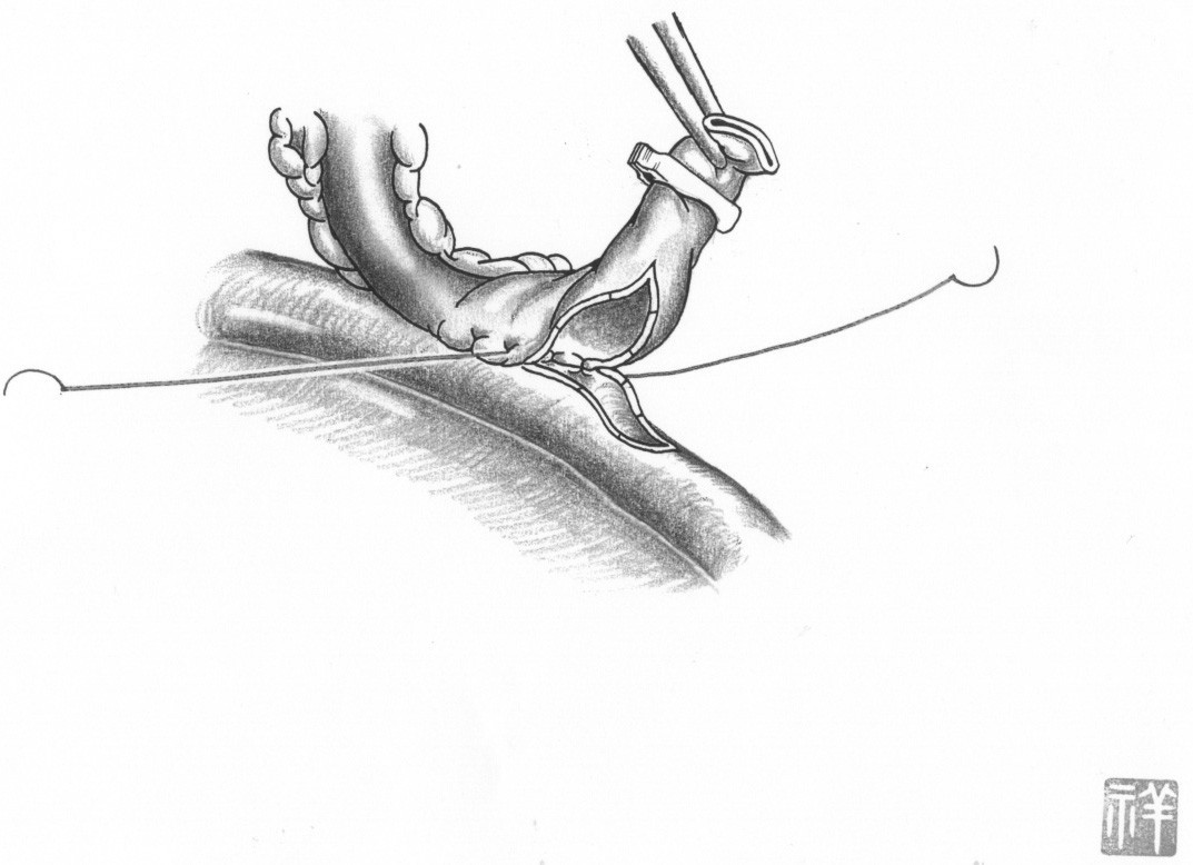 Revival of the side-to-side approach for distal coronary anastomosis | Journal of Cardiothoracic ...