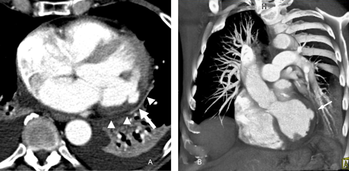Cardiac CT and MRI guide surgery in impending left ventricular rupture ...