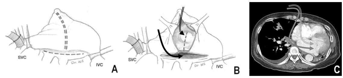 Cox-Maze III procedure with valvular surgery in an autopneumonectomized ...