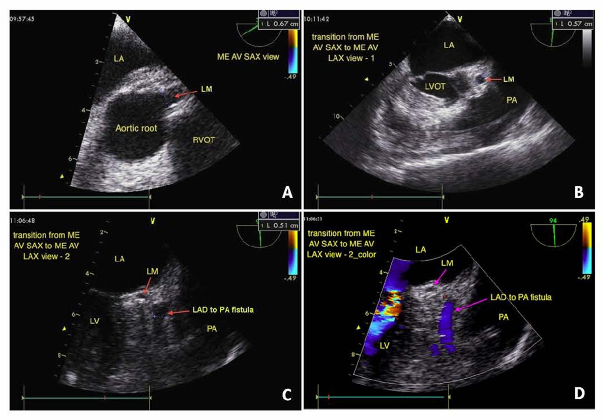Transesophageal echocardiography, more than a diagnostic tool: use ...