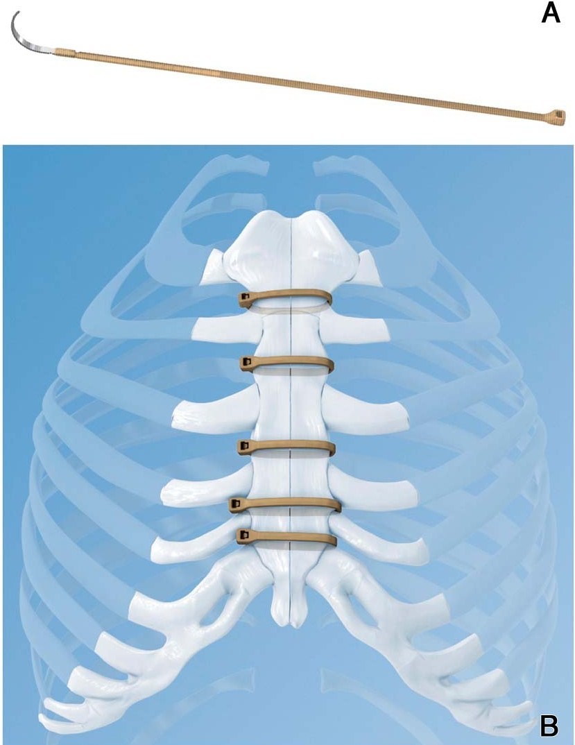 A new cable-tie based sternal closure system: description of the device ...