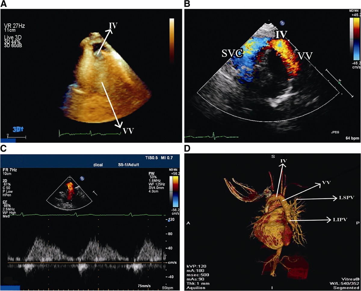 Multiple anomalous left pulmonary venous connections detected with ...