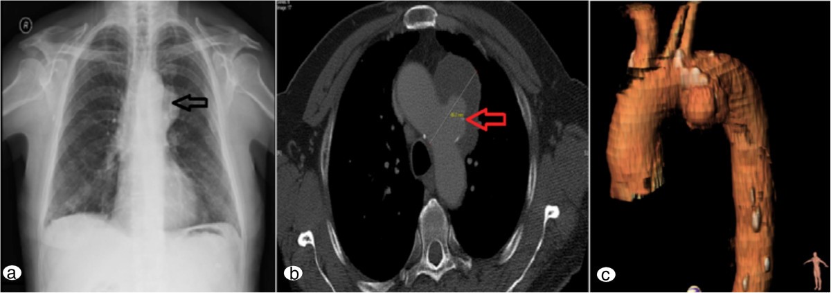 Surgical repair of distal arch psendoaneurysm from ruptured penetrating ...