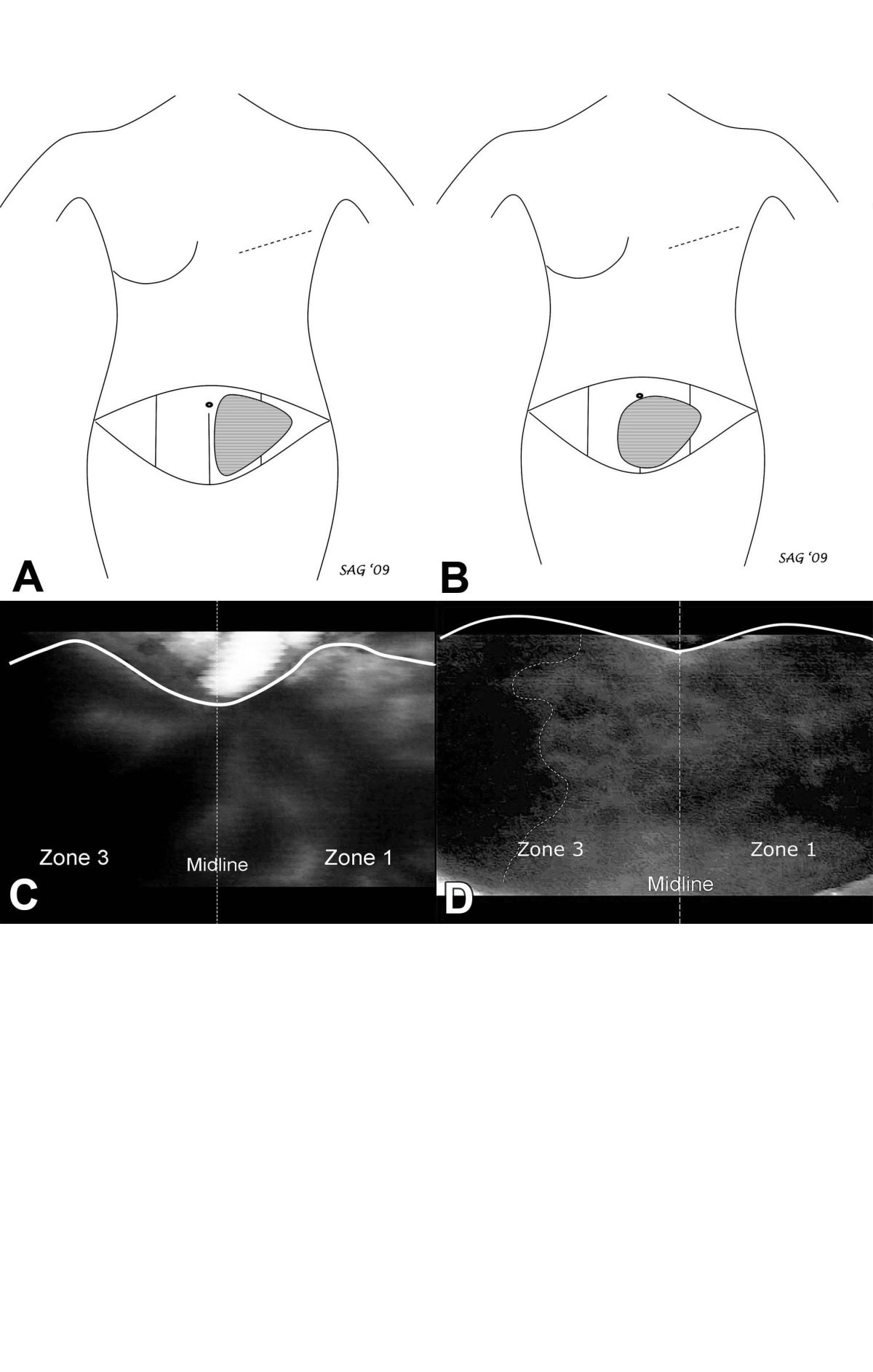 Intraoperative laser angiography using the SPY system: review of the ...