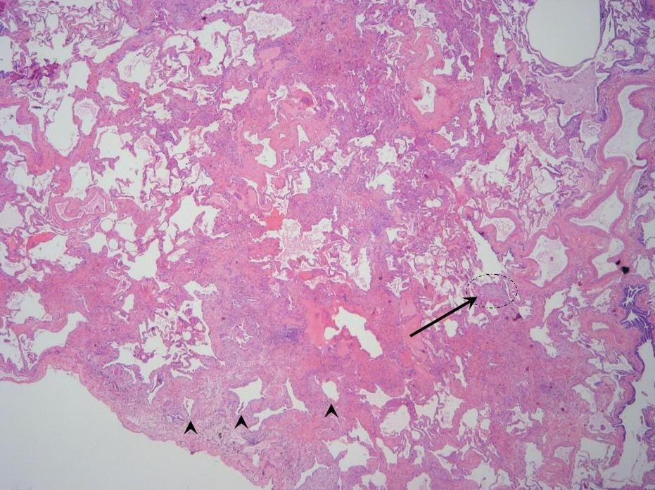 Idiopathic pulmonary fibrosis | Orphanet Journal of Rare Diseases ...