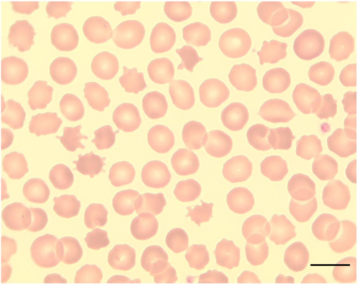 Neuroacanthocytosis Syndromes | Orphanet Journal of Rare Diseases ...