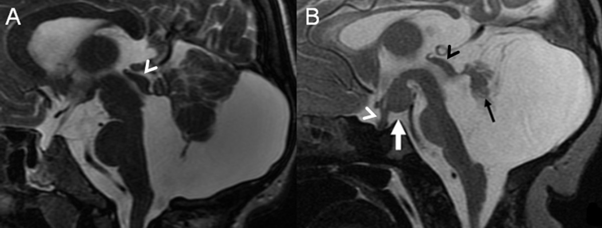 Delineation and Diagnostic Criteria of Oral-Facial-Digital Syndrome ...