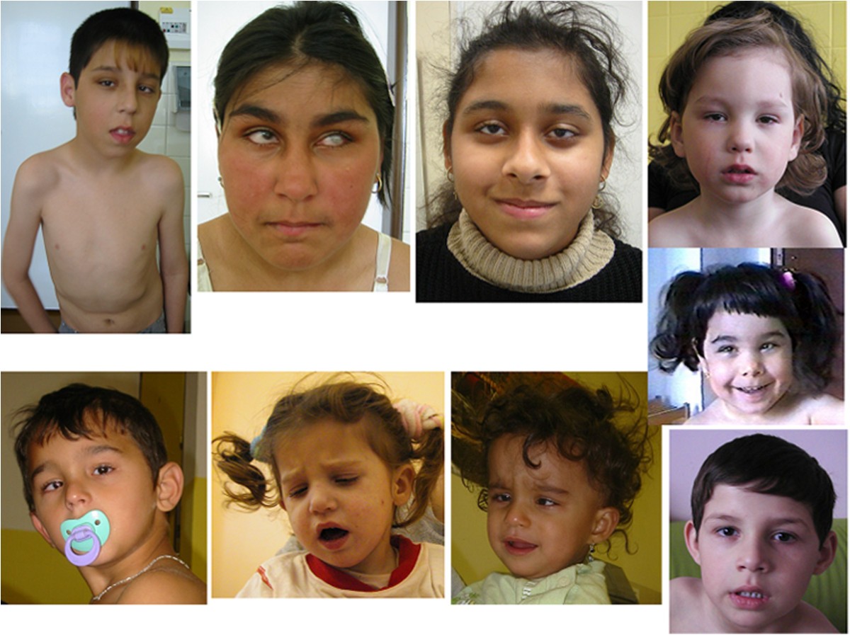 Congenital cataract, facial dysmorphism and demyelinating neuropathy ...