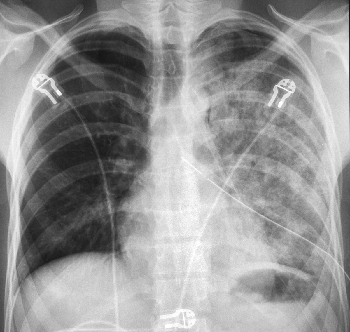 Reexpansion Pulmonary Edema Large Volume Thoracentesis And The Risk Of