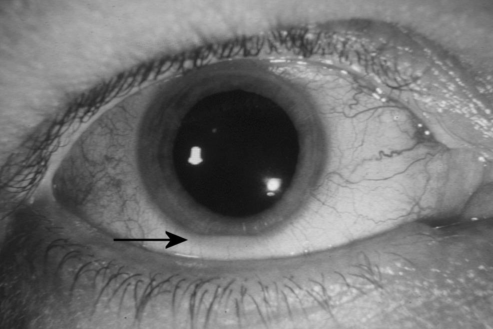 Acute panuveitis with hypopyon in Crohn's disease secondary to medical ...
