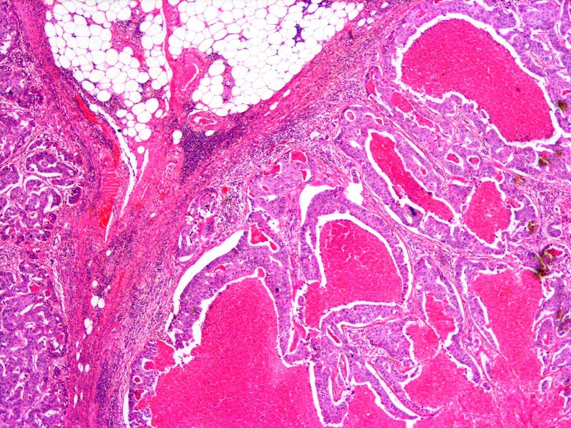 Infiltrating ductal carcinoma breast with central necrosis closely ...