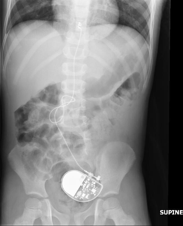 Wandering permanent pacemaker generators in children: a case series ...