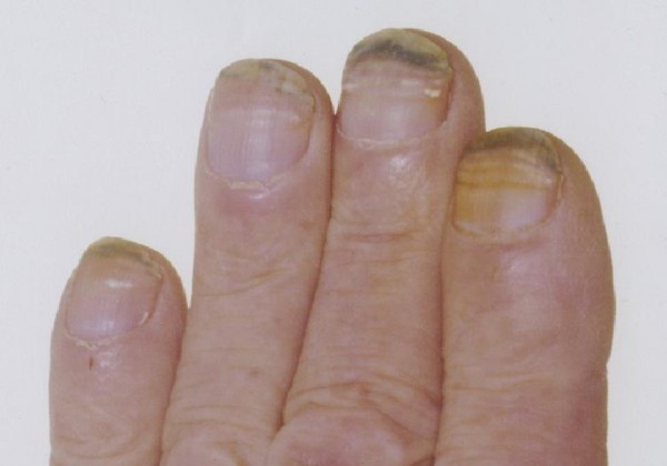 Nail changes secondary to docetaxel chemotherapy : a case report ...