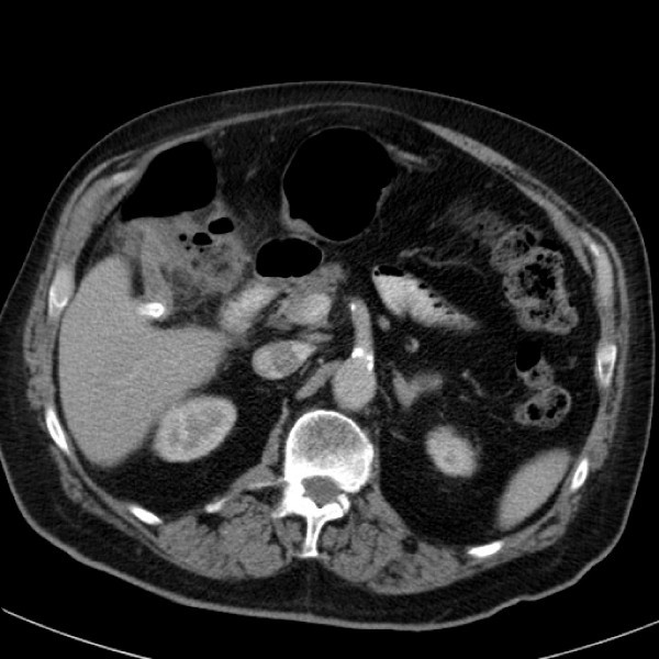 Subhepatically located appendicitis due to adhesions: a case report ...